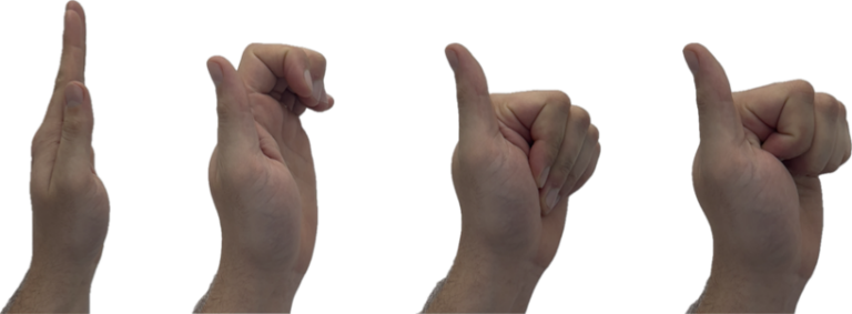 Finger (Phalanx) Fracture - Gateshead Health