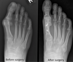 Scarf and Akin Osteotomy - Gateshead Health