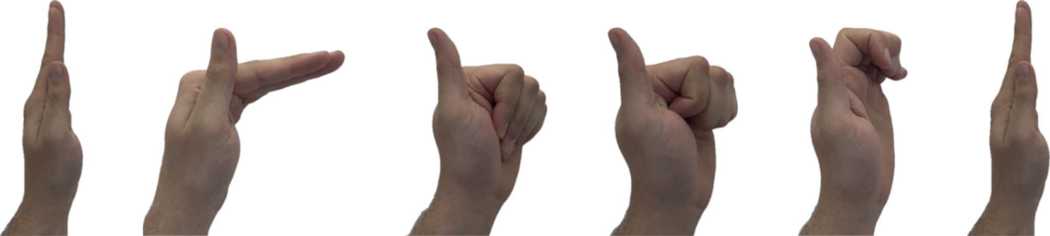 Trigger Finger/Thumb Release Surgery - Gateshead Health