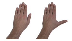 Trapeziectomy - Gateshead Health