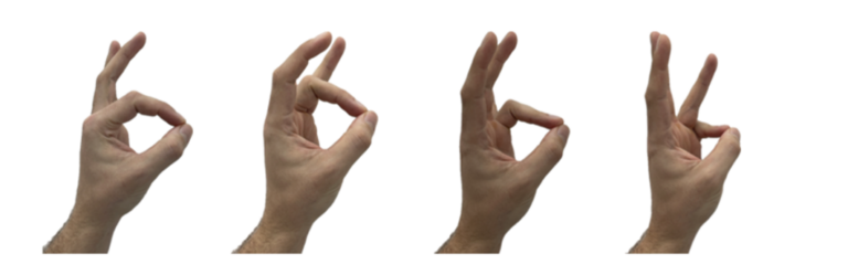 Finger (Phalanx) Dislocation - Gateshead Health