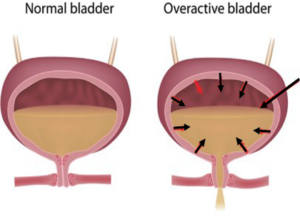 Bladder Training - Gateshead Health