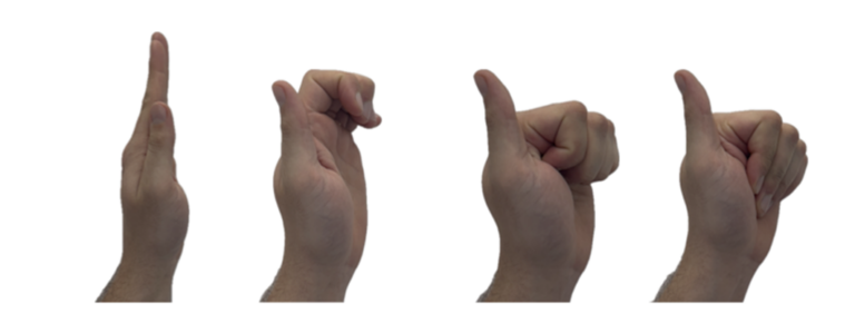 Finger (Phalanx) Dislocation - Gateshead Health