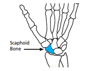 Suspected Scaphoid Fracture - Gateshead Health