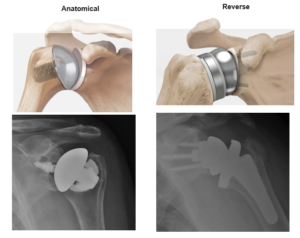 Shoulder Replacement Surgery - Gateshead Health