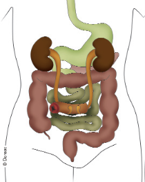 Your Stoma and What to Expect After Surgery - Gateshead Health
