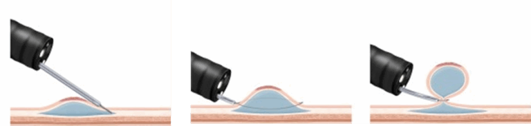 Endoscopic Removal of Large Colonic Polyps - Gateshead Health
