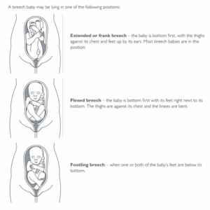 Breech Presentation and External Cephalic Version (ECV) - Turning a ...