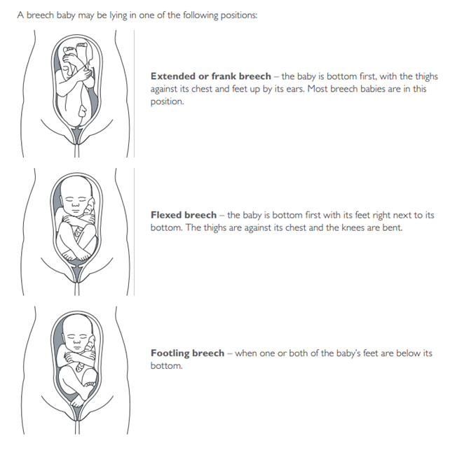 Breech Presentation and External Cephalic Version (ECV) - Turning a ...